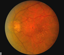 Macular Degeneration